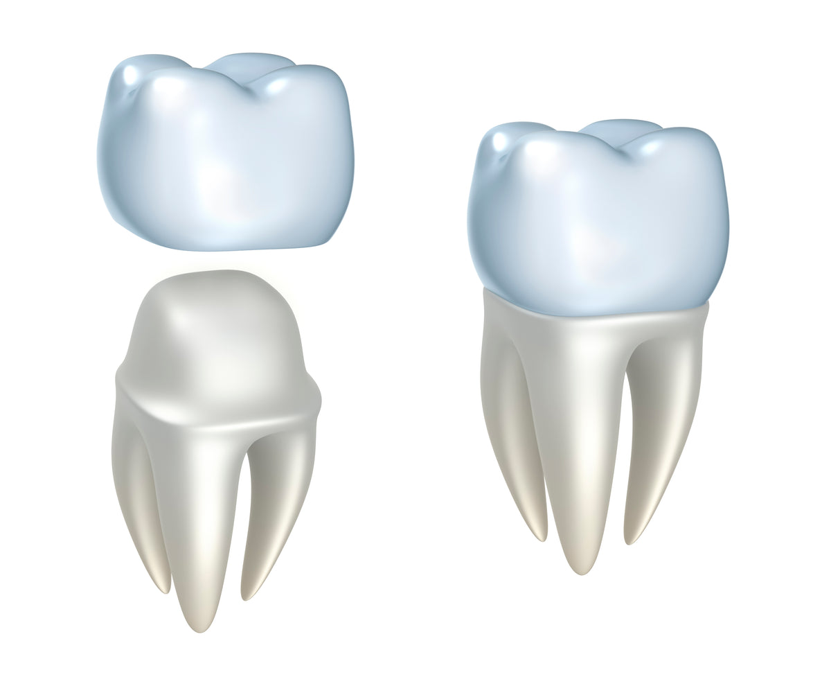 Core Build-Up Materials – Class I Dental Supply